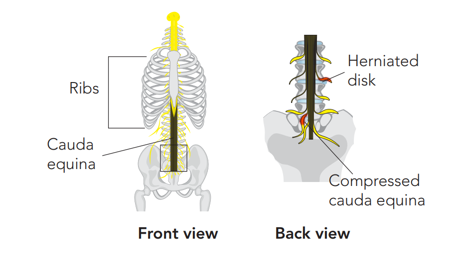 Recognising the Red Flags of Cauda Equina Syndrome - Health City Cayman ...